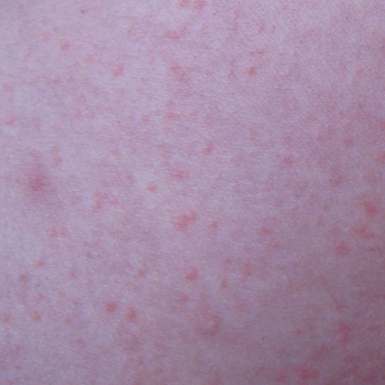 29 Interesting Facts about Heat Rash - World's Facts
